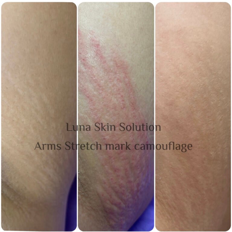 Stretch Marks Camouflage - Luna Skin Solution